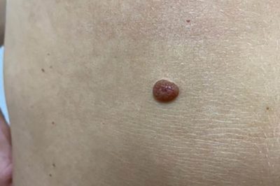 Non Skin Cancer Procedures - Hunter Valley Skin Cancer Clinic