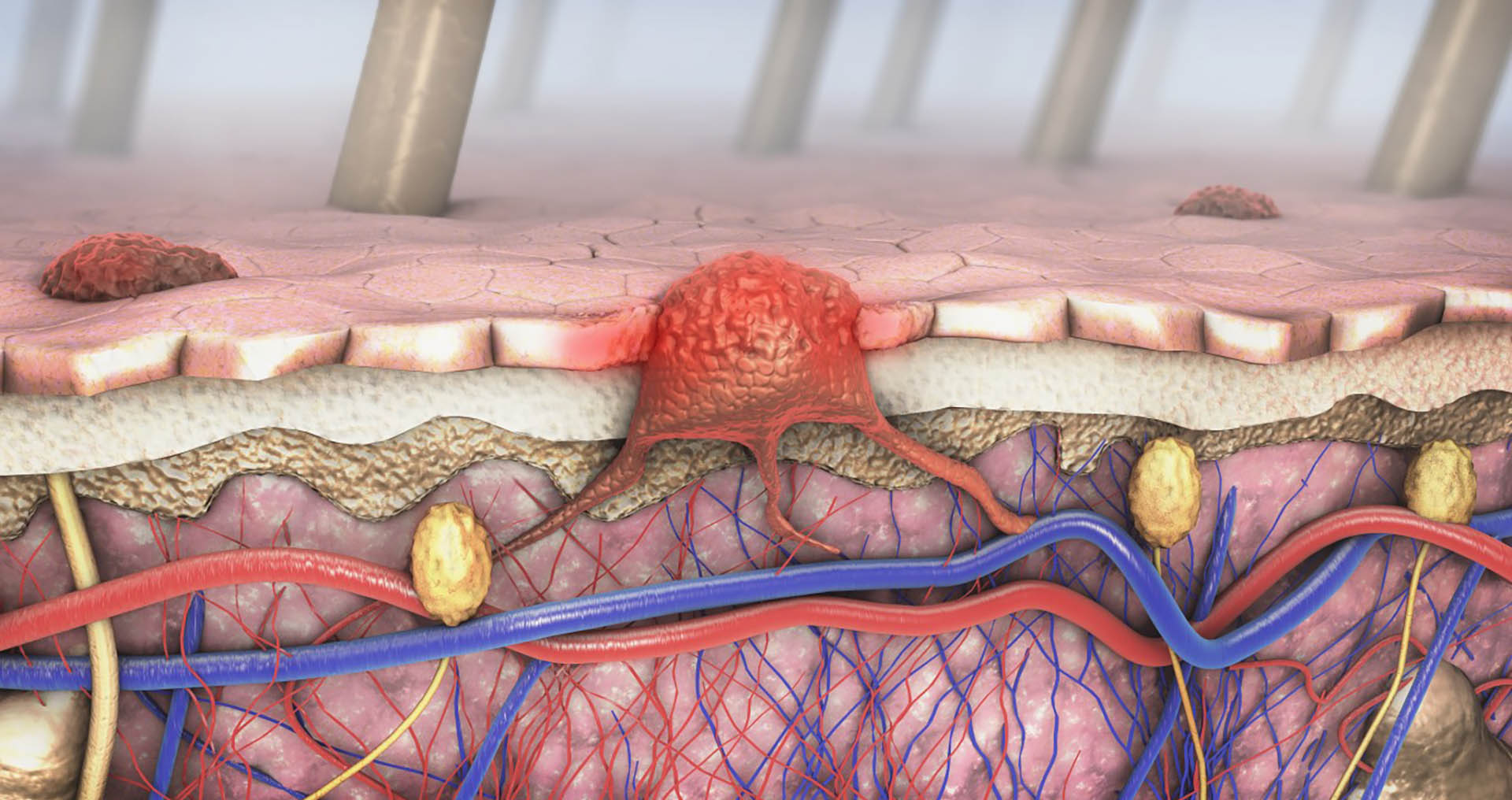 Management of Melanoma - Hunter Valley Skin Cancer Clinic Maitland